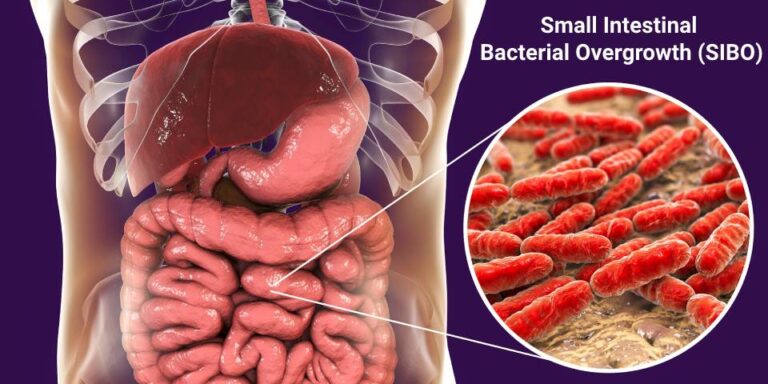 Everything You Should Know About Small Intestinal Bacterial Overgrowth ...