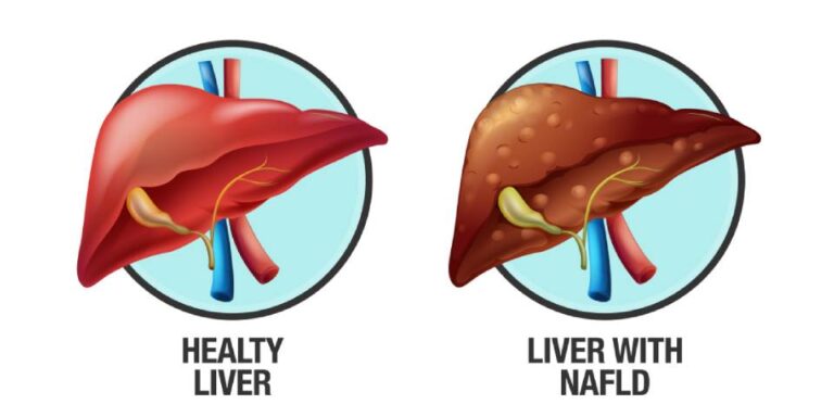 Understanding NAFLD Treatment: Causes, Risk Factors, and Symptoms- Dr ...
